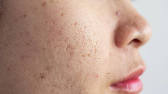 How To Get Rid Of Hyperpigmentation Acne – RAZORVEDA